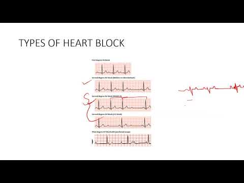ECG (Basics and diagnosis of LVH,RVH,RBBB,LBBB,Hyperkalaemia and Heart block)