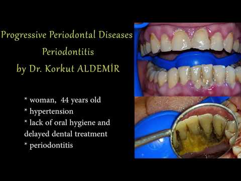 Periodontal Diseases Periodontitis
