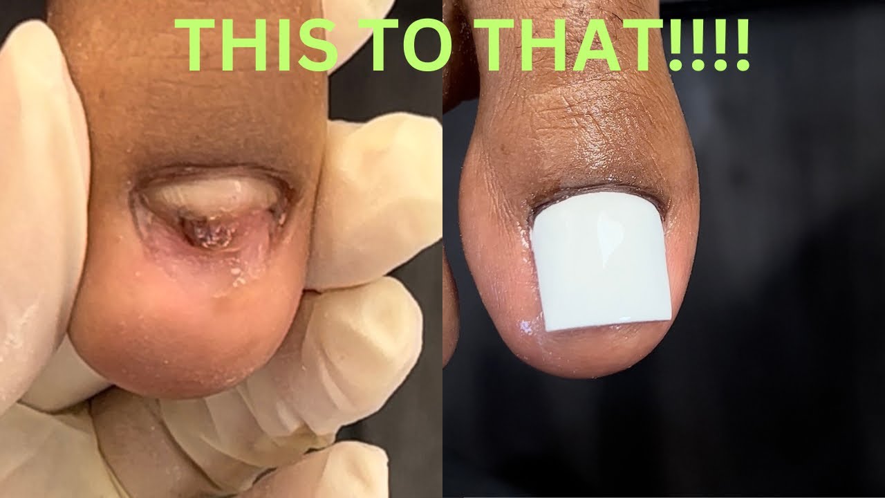 RECONSTRUCTION TOE | OVERLAY ACRYLIC TOES