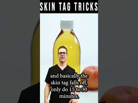 How To Get Rid Of Skin Tags & Wart Removal [Apple Cider Vinegar]