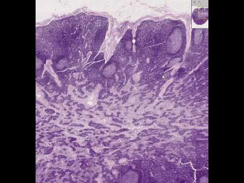 Shotgun Histology Lymph Node