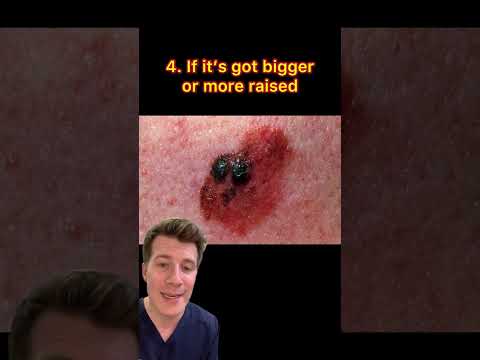 When should I see a doctor about a mole? #shorts #health #skin #cancer