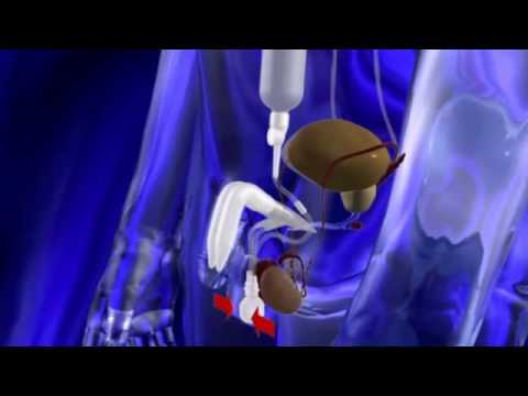 Dr Phillip Katelaris how do penile implants work