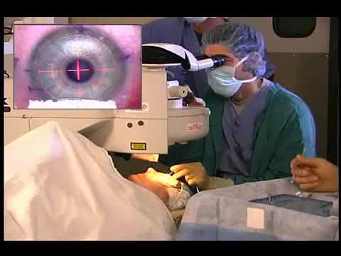 LASIK (Laser in situ keratomileusis)
