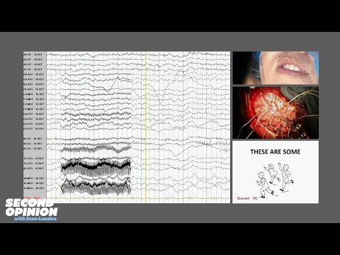 MEDICAL INNOVATIONS | STIMULATION BRAIN MAPPING | SECOND OPINION WITH JOAN LUNDEN |