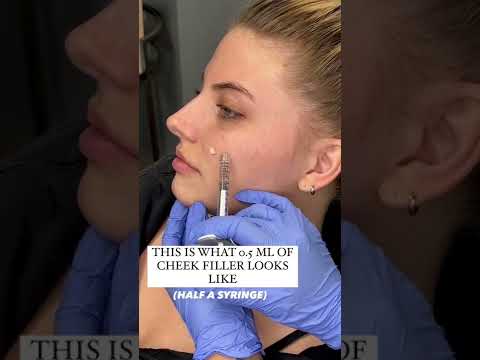 Demonstration of where cheek filler would be placed!! #cheekfiller #cheekfillers #contouredcheeks