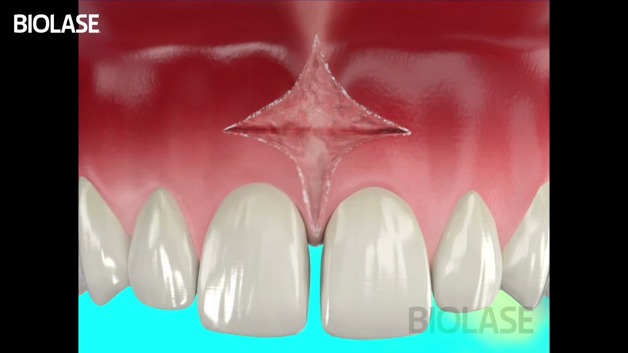 Waterlase Dentistry - Maxillary Frenectomy