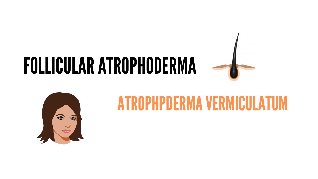 FOLLICULAR ATROPHODERMA| ATROPHODERMA VERMICULATUM| KERATOSIS PILARIS ATROPHICANS| DERMATOLOGY