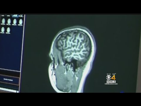 Study Of NFL Players' Brains Shows 99% Had CTE