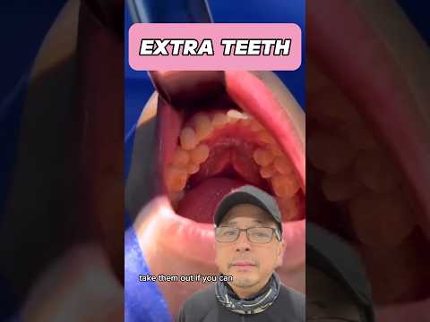 What to Do if Your Patient Has Supernumerary Teeth | In Office to Hands On Dental Training #shorts