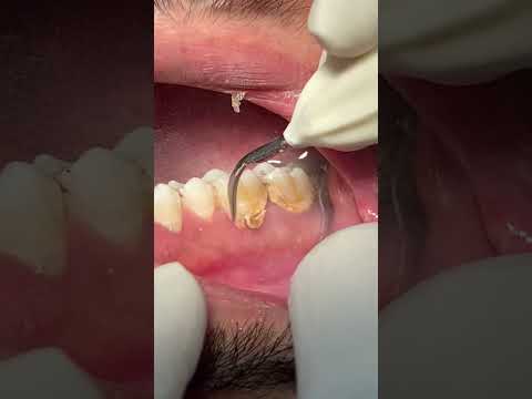 Cleaning teeth 🦷 #dental #scaling #satisfying
