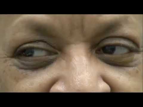 Cranial Nerve VI Palsy