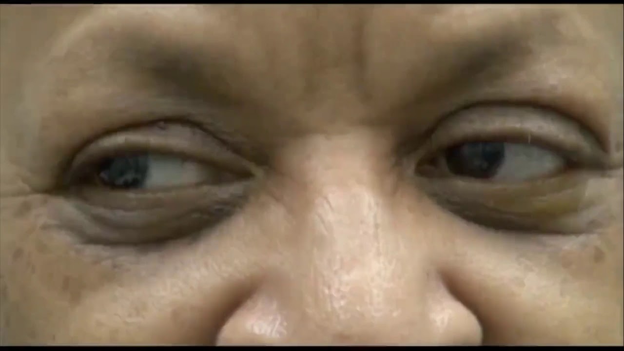 Cranial Nerve VI Palsy