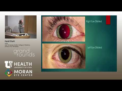 Leukemic Infiltration of the Iris