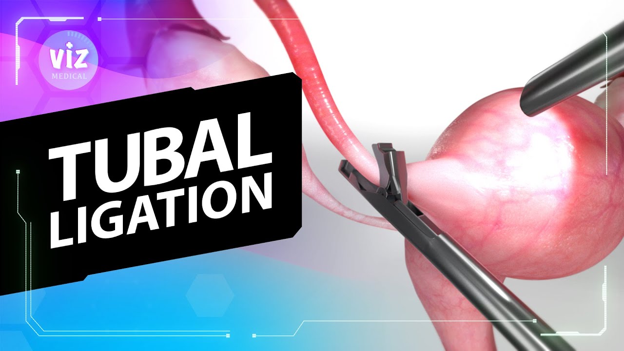 3 techniques for permanent birth control (3D Animation)