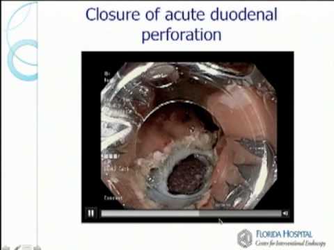 The Convergence of Therapeutic Endoscopy and MIS