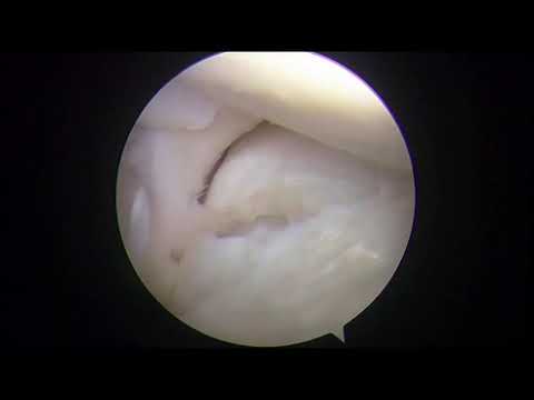Surgical Management of Discoid Lateral Meniscus With Anterior Peripheral Instability