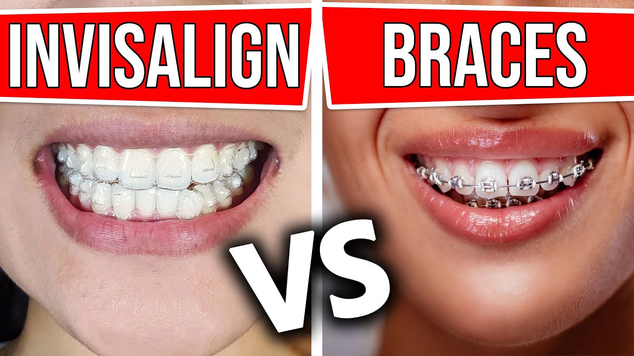 Invisalign vs Braces - 5 UNIQUE Benefits of Invisalign! McKinney Orthodontist