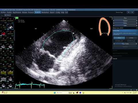 IQ 497 AUTOEF DCM ECHO PAC ANALYSIS ECHOCARDIOGRAPHY
