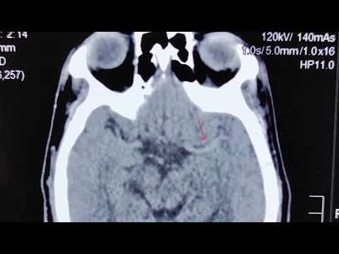 Left hyperdense MCA(middle cerebral artery) sign in ct brain in acute stroke
