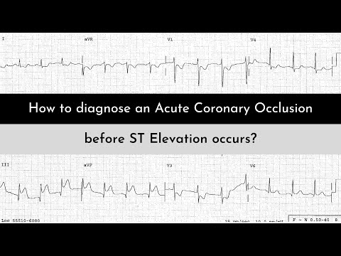 STEMI-NSTEMI vs OMI-NOMI: A Paradigm Shift in ECG interpretation of MI