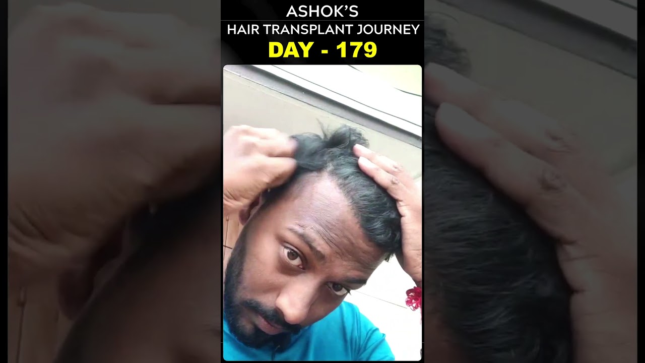 #AskDrJohnWatts | DAY - 179 of ASHOK’S HAIR TRANSPLANT JOURNEY | #besthairtransplant #drjohnwatts