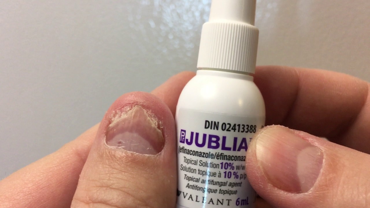 Treating Fingernail Fungus with Jublia (Efinaconazole 10%) - Video #4