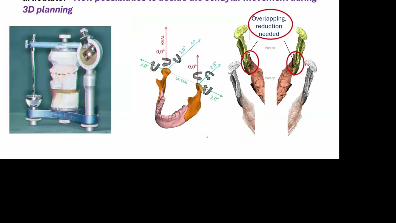 Virtual Surgical Planning and Patient specific Solutions in Orthognathic Surgery (snippet)