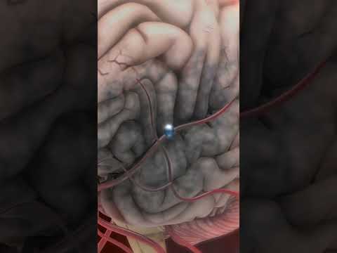 How Paralysis Happens in 60 Seconds (Animated Explanation)#shorts