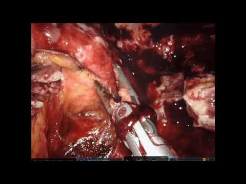 Robot Assisted Hartmann's Procedure - Unedited