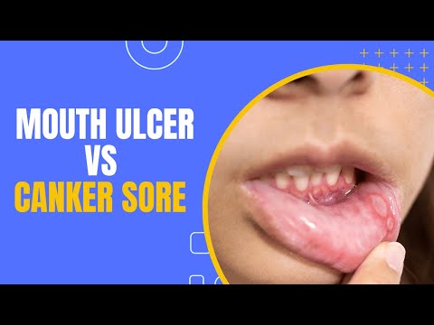 Mouth Ulcer vs Canker Sore: 7 Medical Effective Treatments