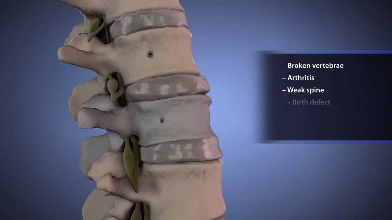 Spinal Instrumentation