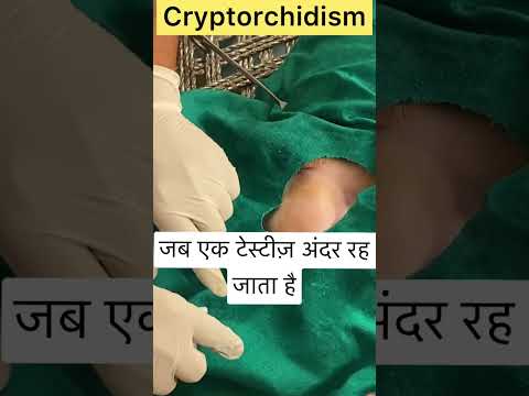 Cryptorchidism l Dr Umar Khan