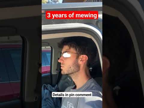 3 years of mewing 🫢
