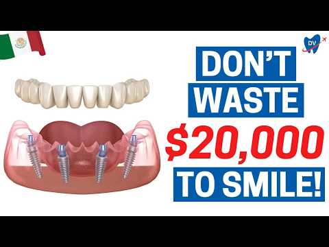 Cost of All on 4 Dental Implants in Mexico (PATIENT REVIEW Inside!)