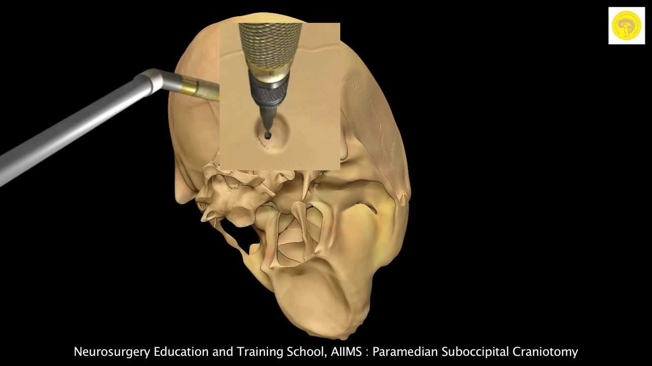 Neurosurgery 3D Animation Video : Paramedian Suboccipital