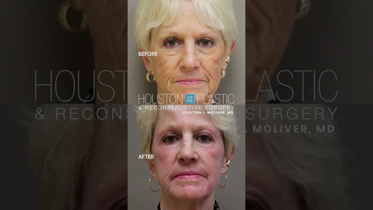 Fractional CO2 Laser #co2laser #facialrejuvenation #wrinkletreatment