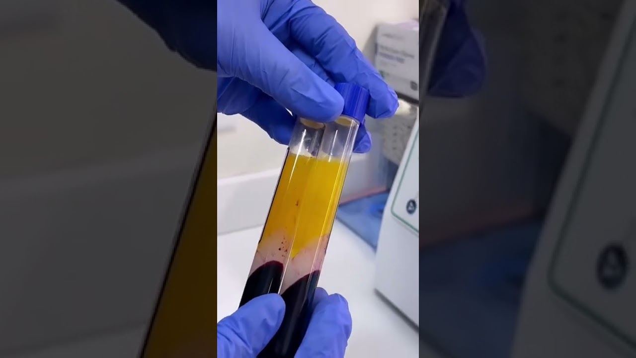 Platelet rich plasma for erectile dysfunction #prp #erectiledysfunction #penis