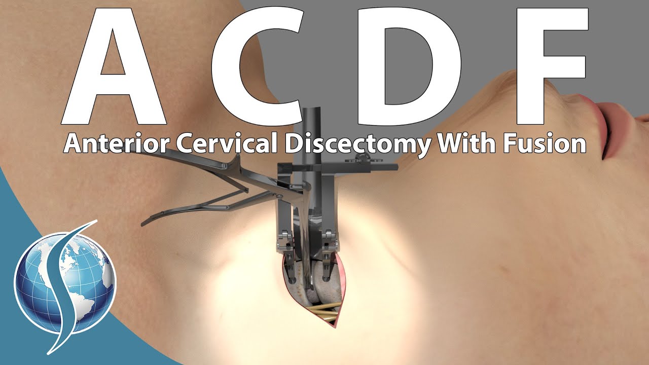 Anterior Cervical Discectomy and Fusion
