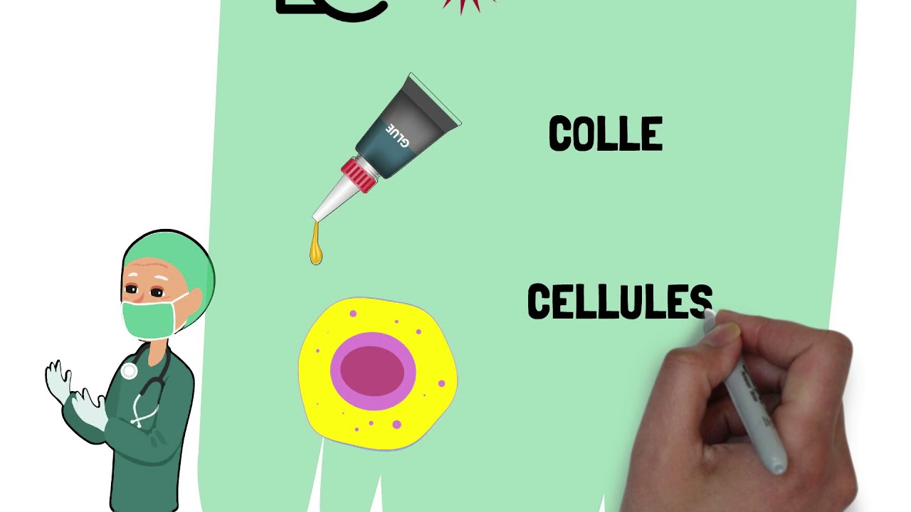 Comprendre les fistules anales