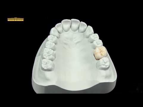 Ceramic Teeth - ceramic crown Latest Price, Manufacturers & Suppliers