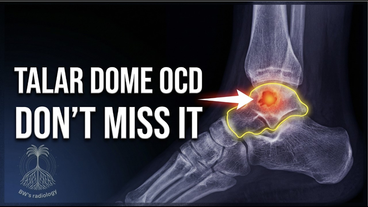 Ankle: Talar Dome Osteochondritis Dissecans Explained