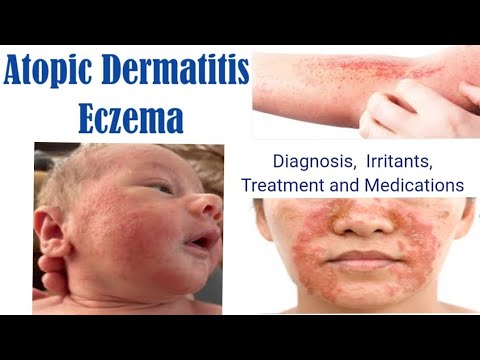 Atopic Dermatitis | Eczema | Diagnosis, Irritants, Treatment and Medications