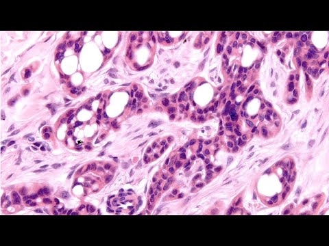 Primary cutaneous cribriform carcinoma McKee