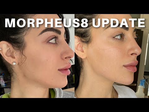 INMODE MORPHEUS8 RESULTS UPDATE (2/3 TREATMENTS IN)