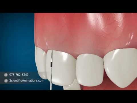Esthetical Crown Lengthening Animation | Dental Animation