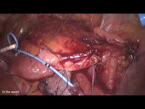 Laparoscopic reimplantation of the ureter into the bladder for ureterc stricture caused by endometri