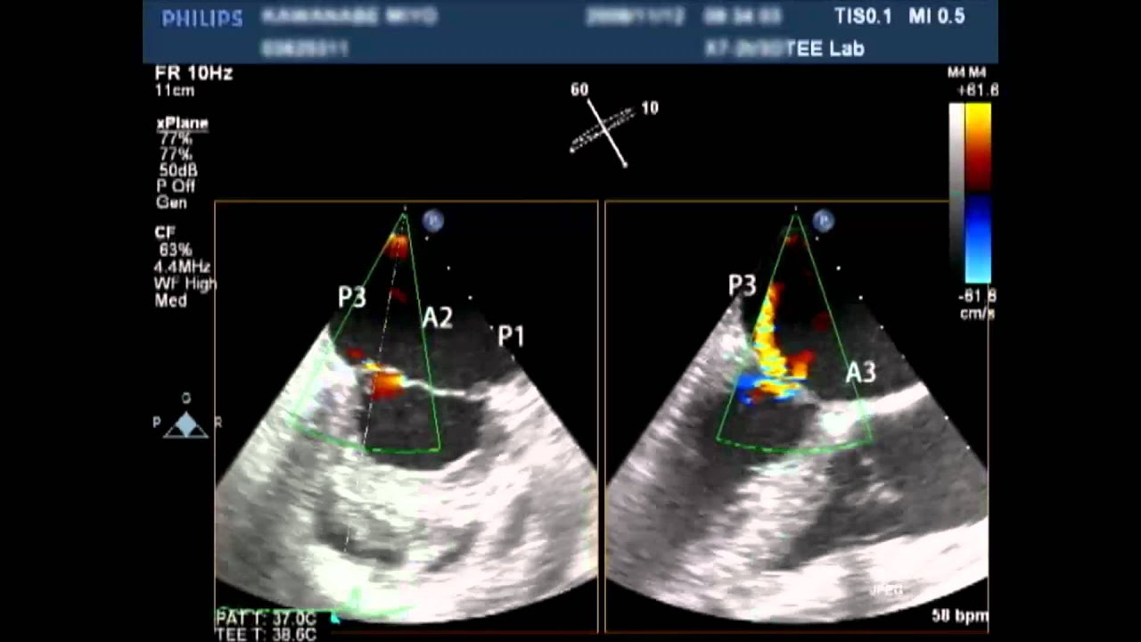 A3 ME mitral commissural CD