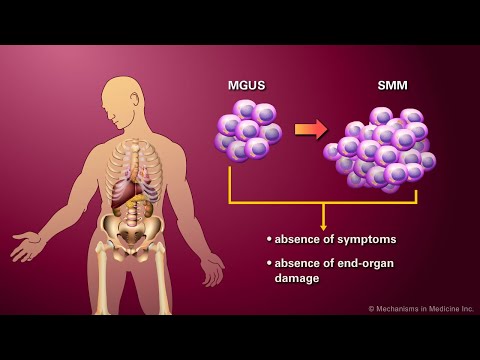 Monoclonal Gammopathy of Undetermined Significance, Smoldering Multiple Myeloma and Multiple Myeloma