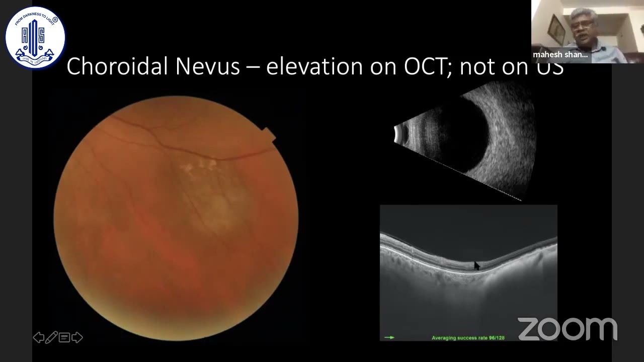 Multimodal Imaging in Intraocular Tumors, the New Paradigm - Dr. Mahesh Shanmugam